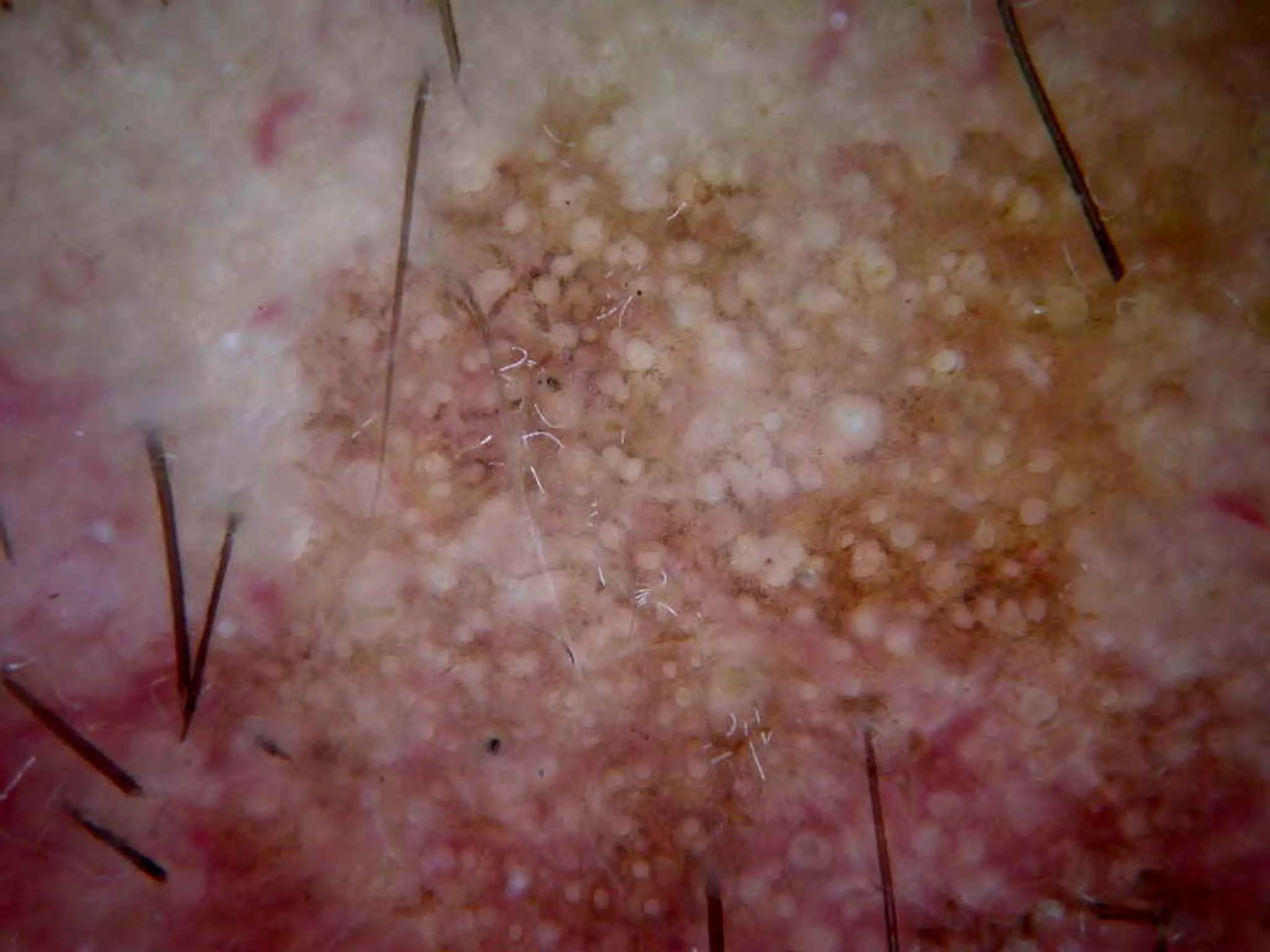 Pigmented actinic keratosis | PPT