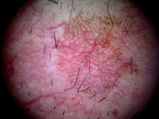 Pigmented actinic keratosis | PPT | Skin and Dermatology | Diseases and ...