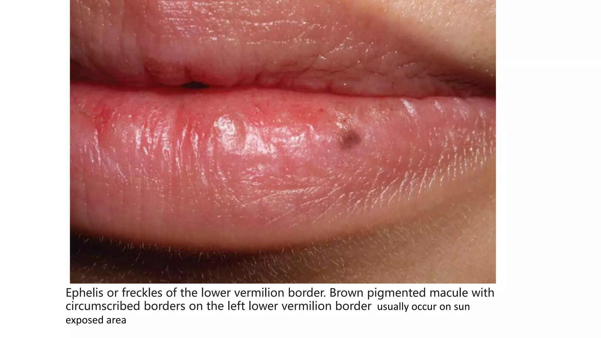 pigmented lesion of oral cavity Assadawy.pptx