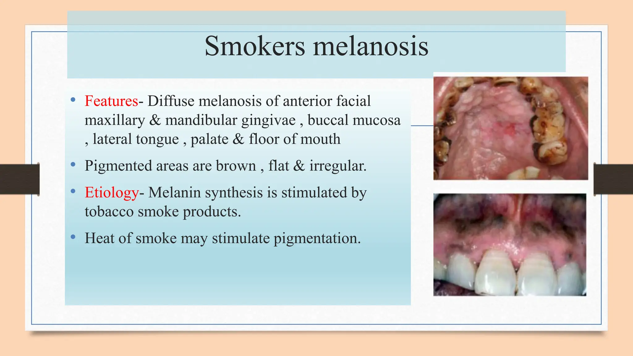 Exogenous and endogenous Pigmented lesion of oral cavity | PPTX