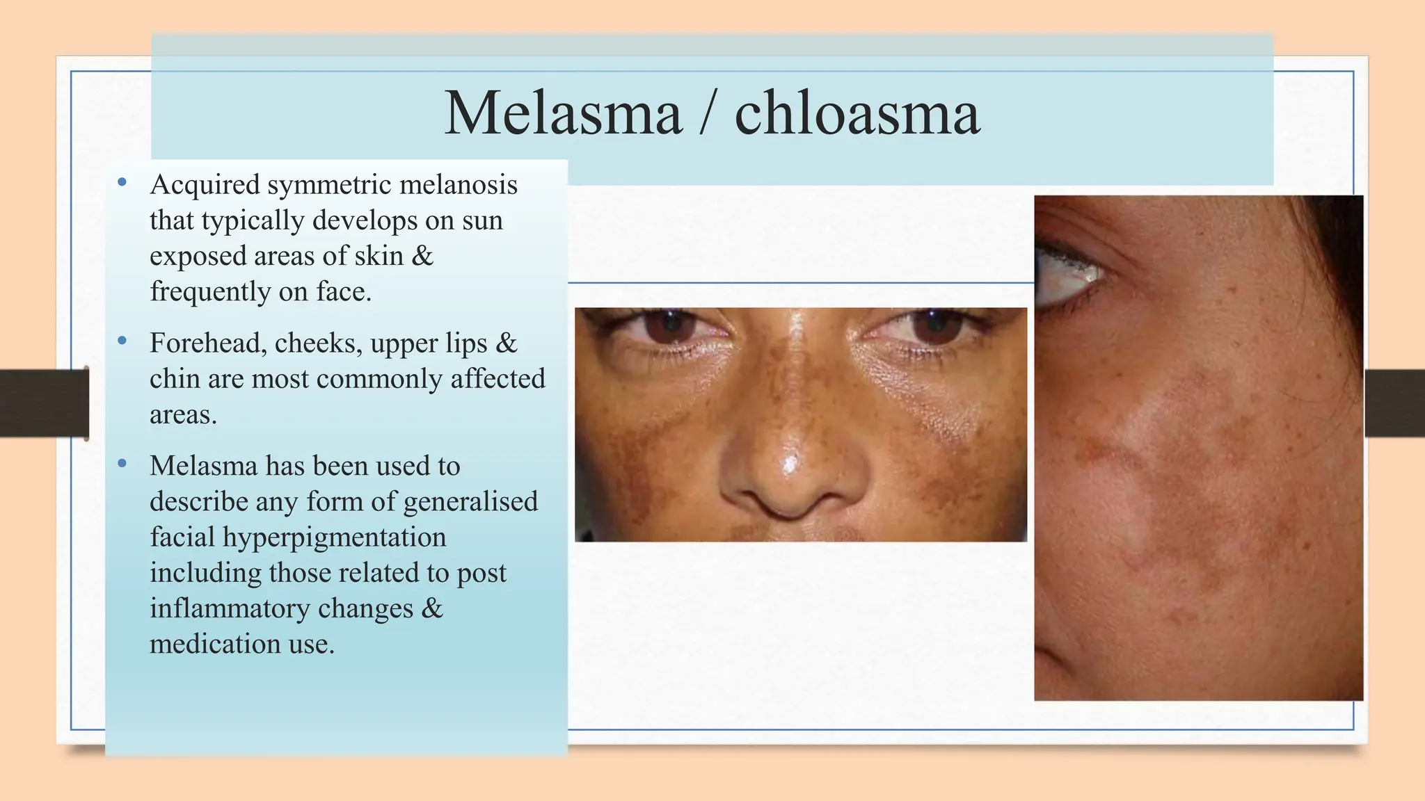 Exogenous and endogenous Pigmented lesion of oral cavity | PPTX