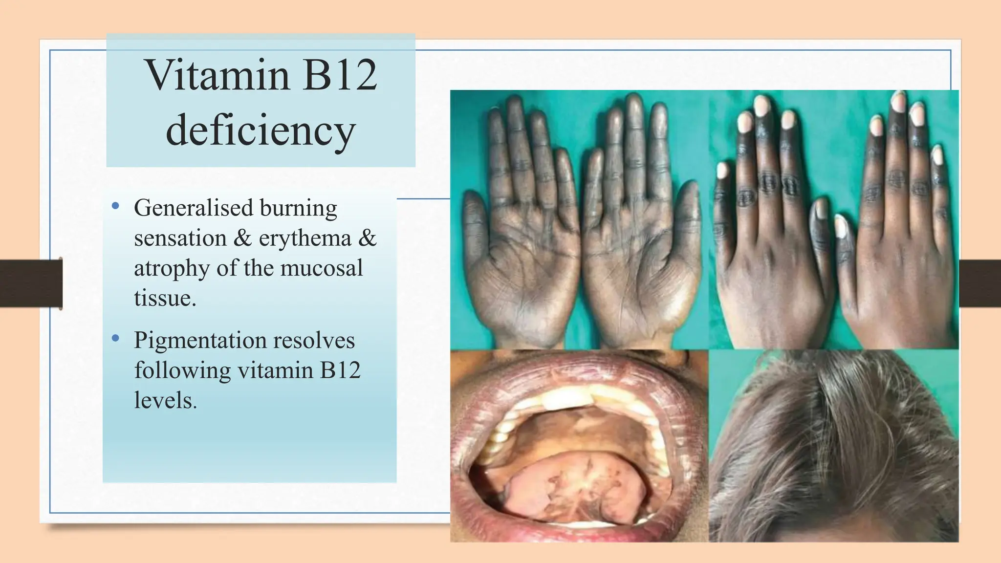 Exogenous and endogenous Pigmented lesion of oral cavity | PPTX