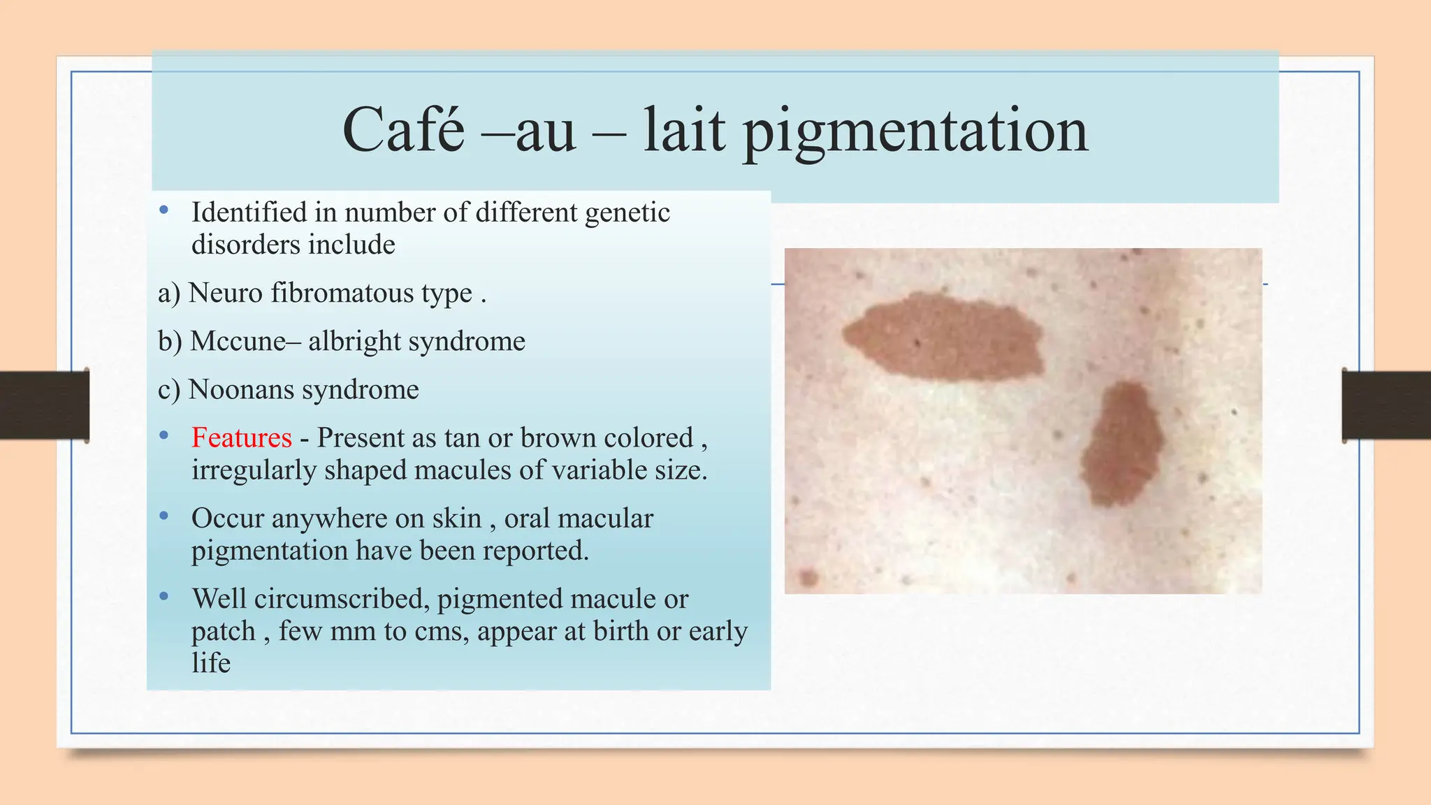 Exogenous and endogenous Pigmented lesion of oral cavity | PPTX