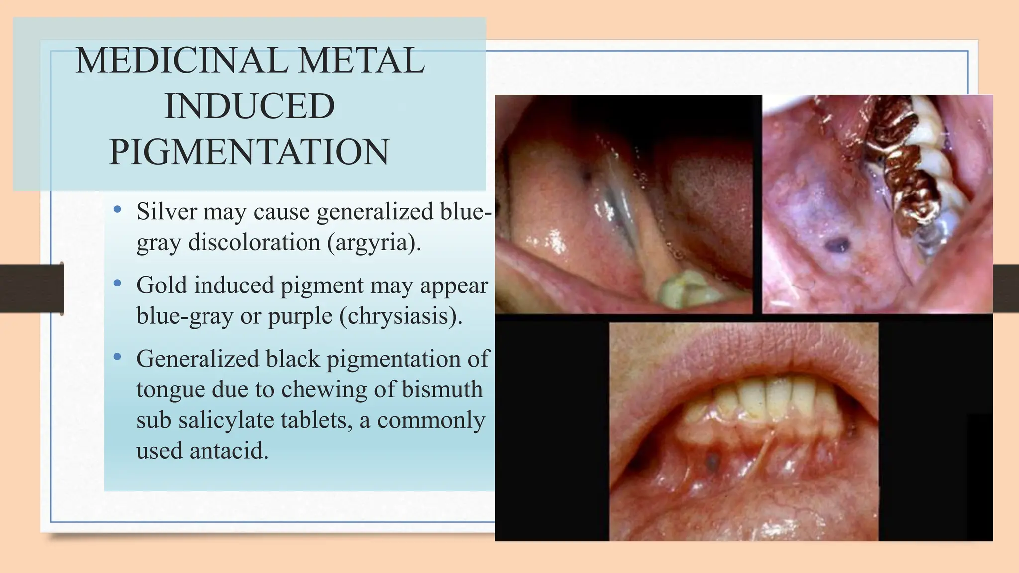 Exogenous and endogenous Pigmented lesion of oral cavity | PPTX