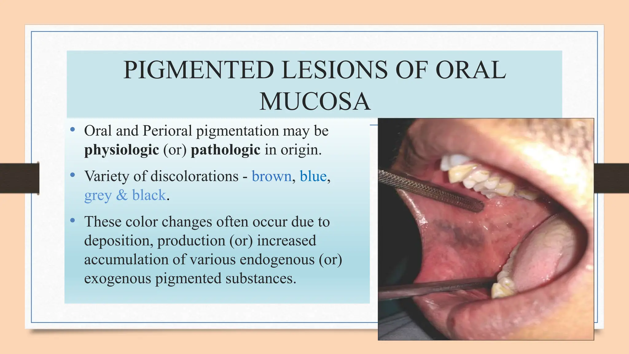 Exogenous and endogenous Pigmented lesion of oral cavity | PPTX