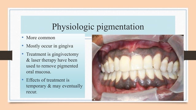 Exogenous and endogenous Pigmented lesion of oral cavity | PPTX | Skin ...