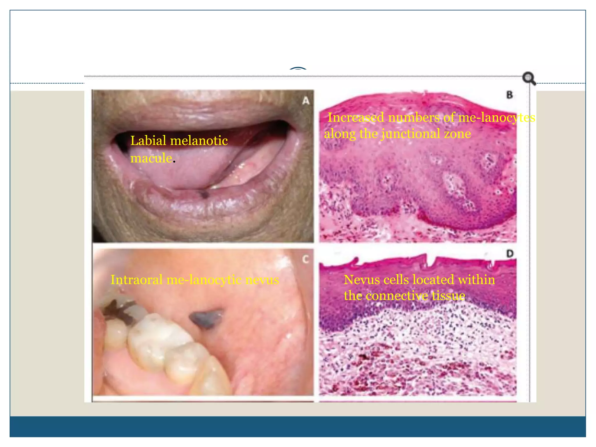 Pigmented lesions of oral cavity | PPTX