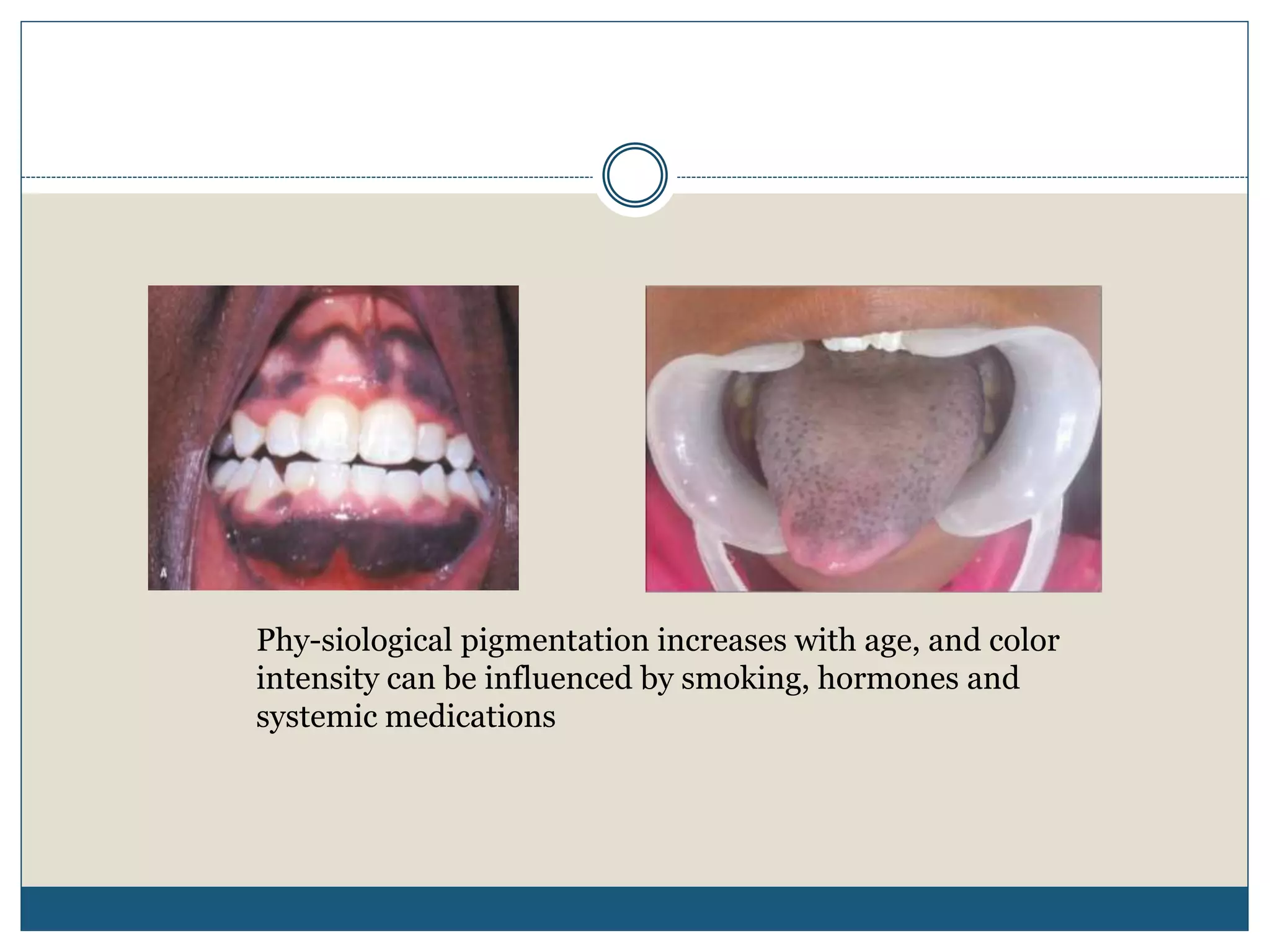 Pigmented lesions of oral cavity | PPTX