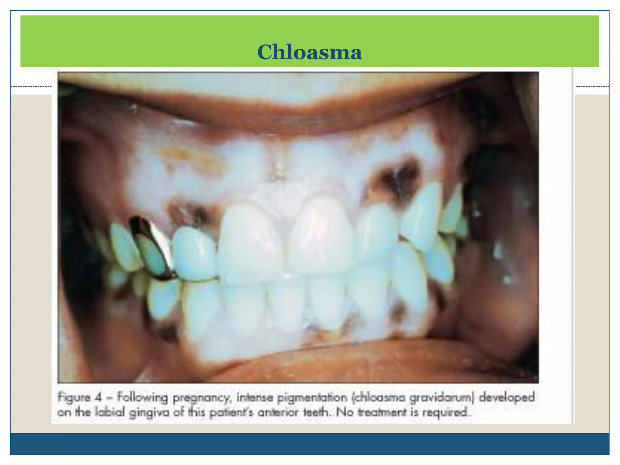 Pigmented lesions of oral cavity | PPTX
