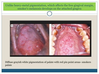 Pigmented lesions of oral cavity | PPTX