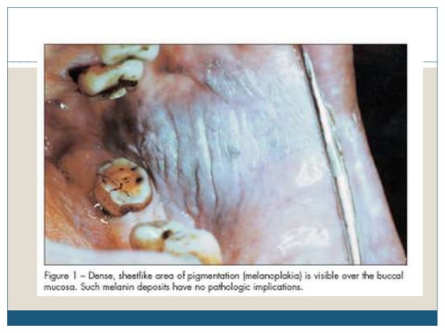 Pigmented lesions of oral cavity | PPTX