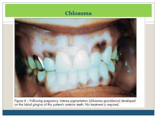 Pigmented lesions of oral cavity | PPTX
