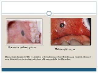 Oral Melanocytic Nevus