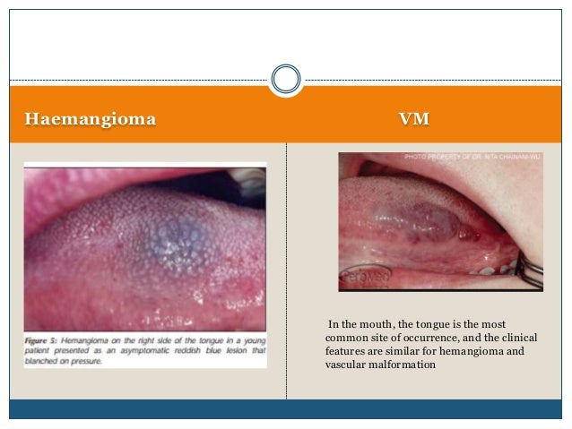 Pigmented lesions of oral cavity
