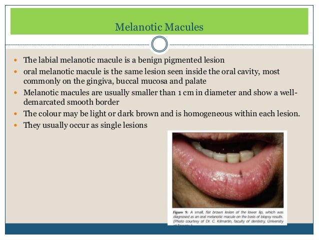 Pigmented lesions of oral cavity