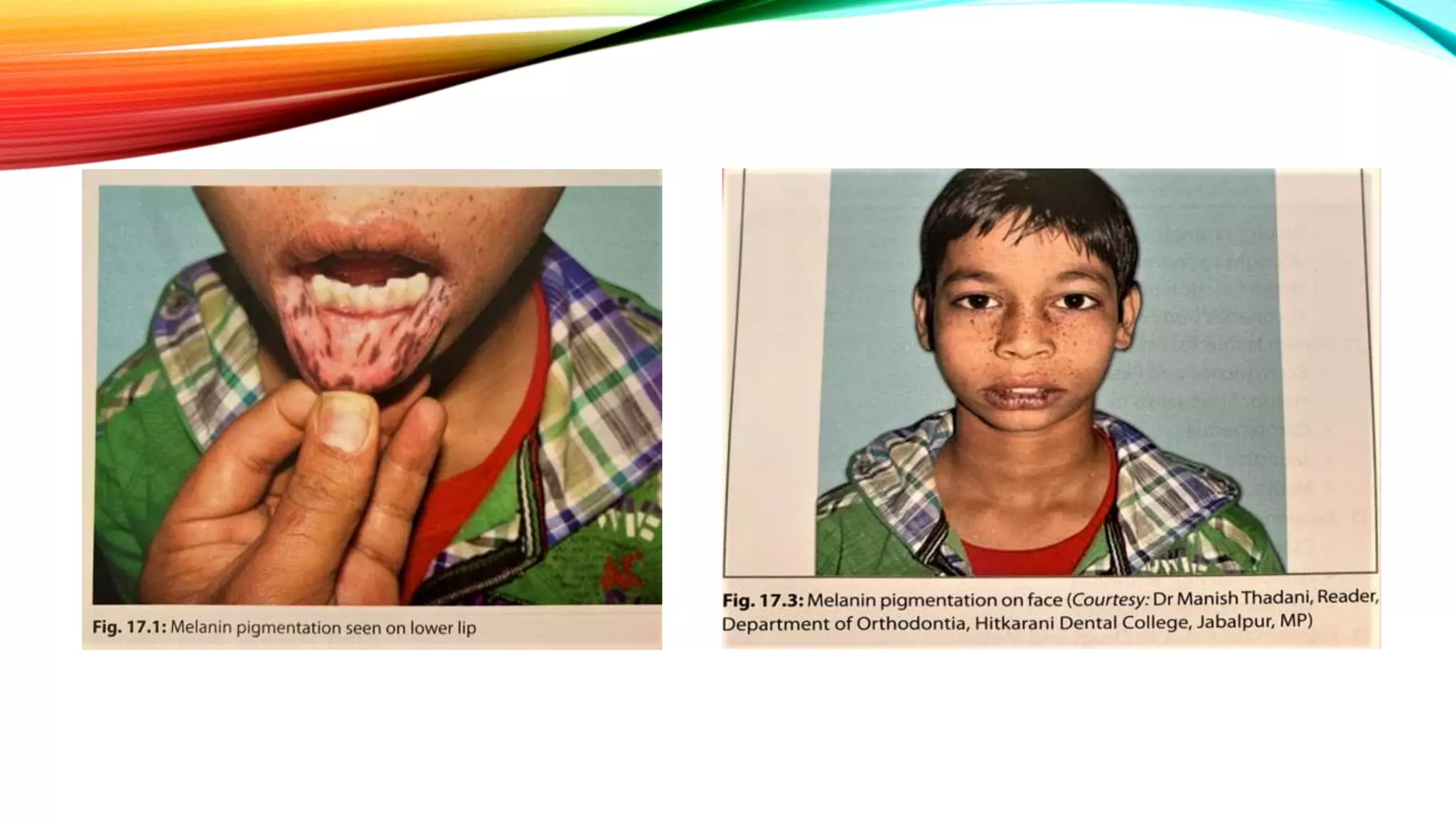 Pigmented lesions of oral cavity (Oral Medicine and Radiology) | PPTX