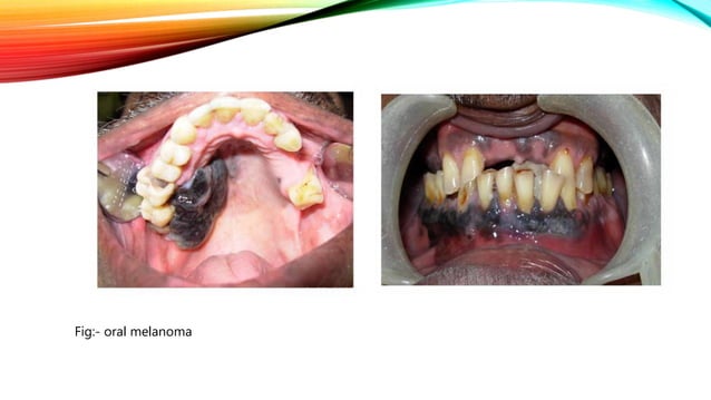 Pigmented lesions of oral cavity (Oral Medicine and Radiology) | PPTX
