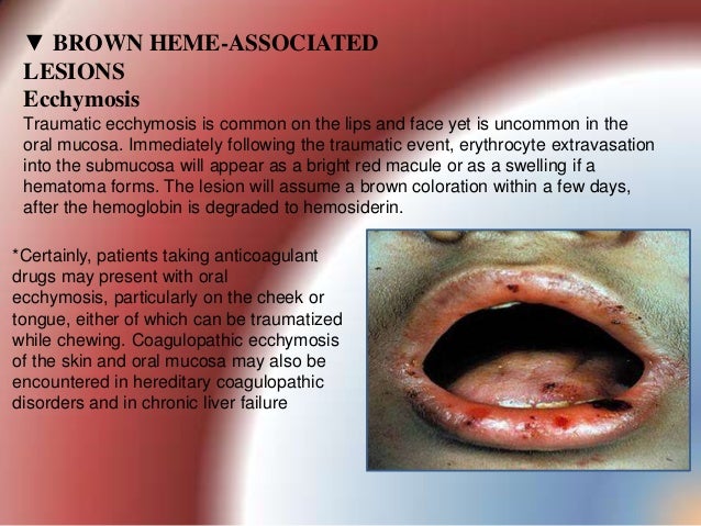 Pigmented lesions of oral mucosa
