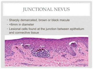 Pigmented lesions of the oral cavity | PPTX