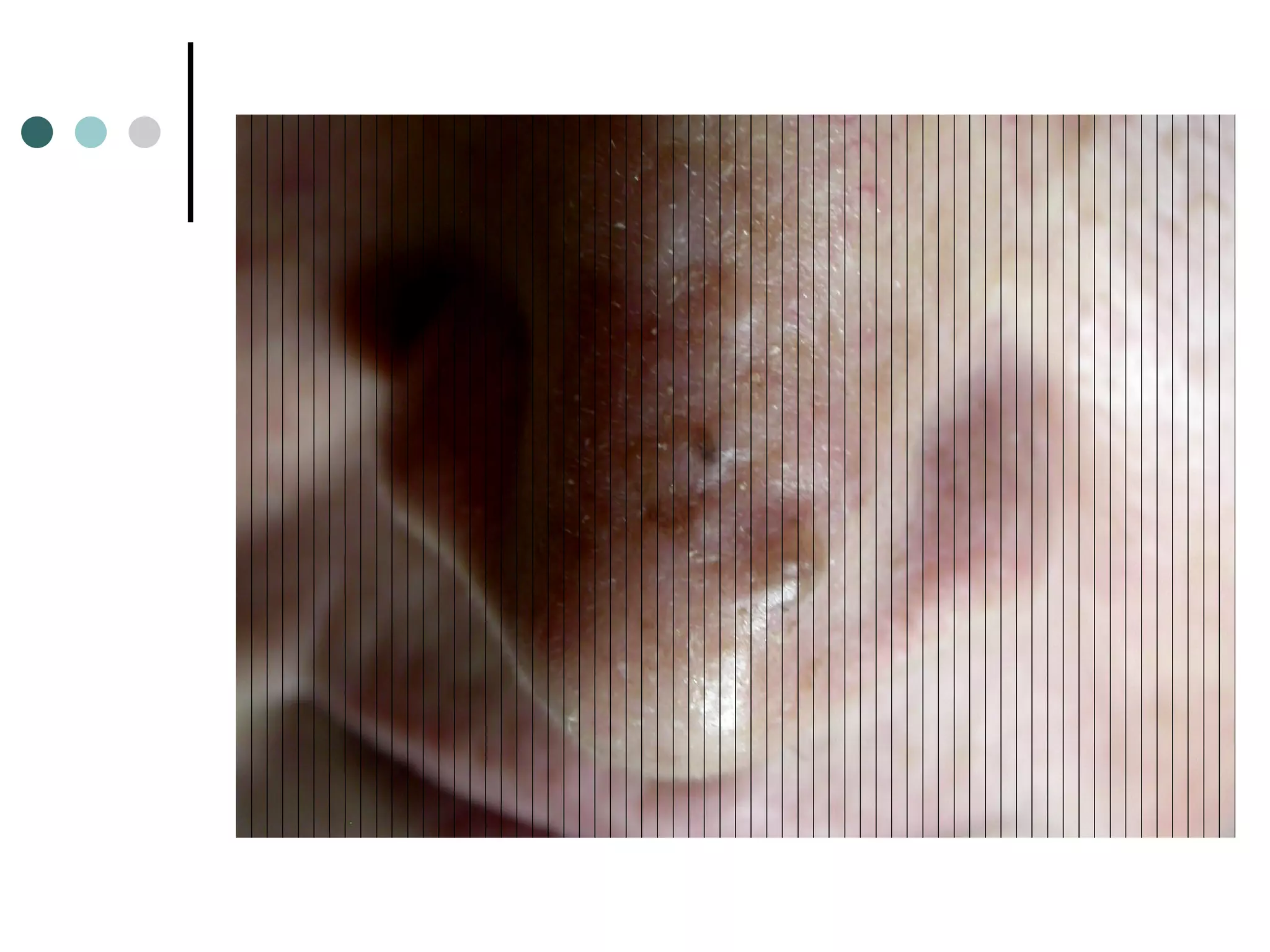 Pigmented Lesions On The Nose. | PPT