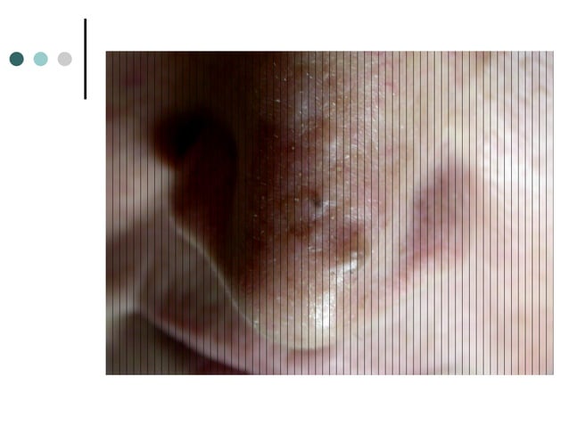 Pigmented Lesions On The Nose. | PPT