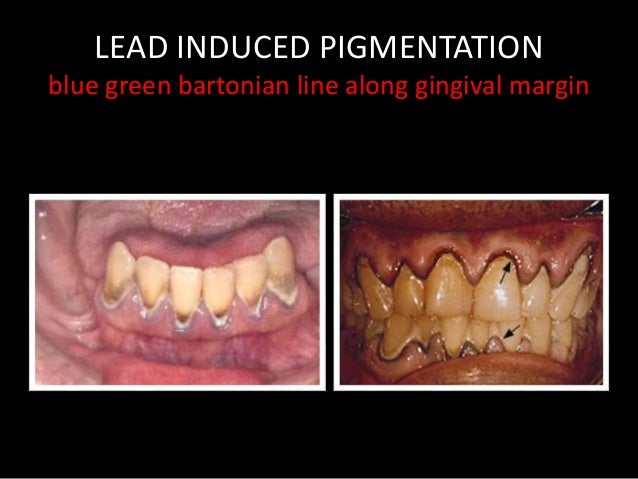 Pigmented lesions of oral cavity