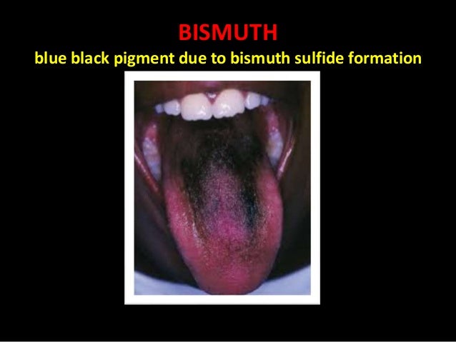 Pigmented lesions of oral cavity