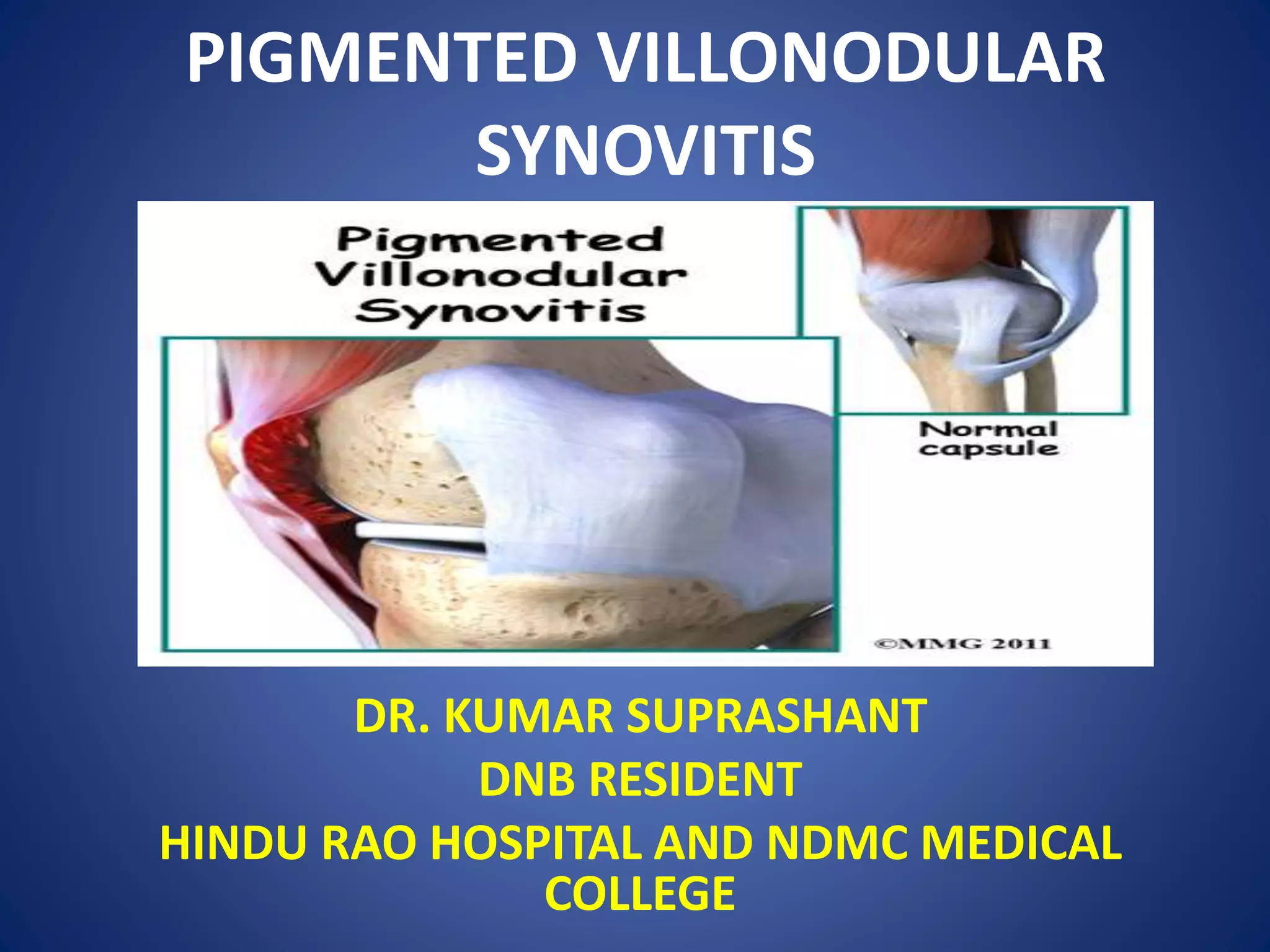 Pigmented villonodular synovitis31may16 | PPTX