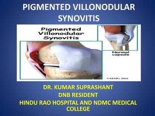 Pigmented villonodular synovitis31may16 | PPTX