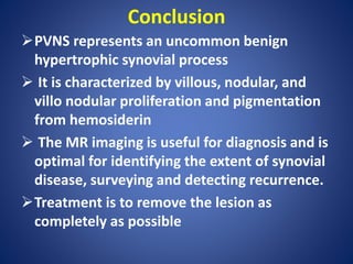 Pigmented villonodular synovitis31may16 | PPTX