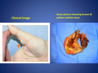 Pigmented villonodular synovitis31may16 | PPTX