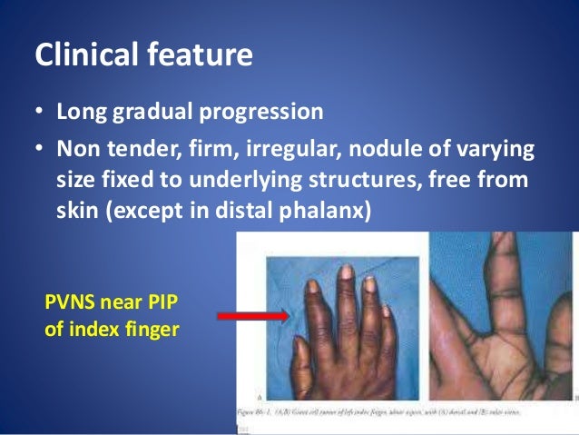 Pigmented villonodular synovitis31may16