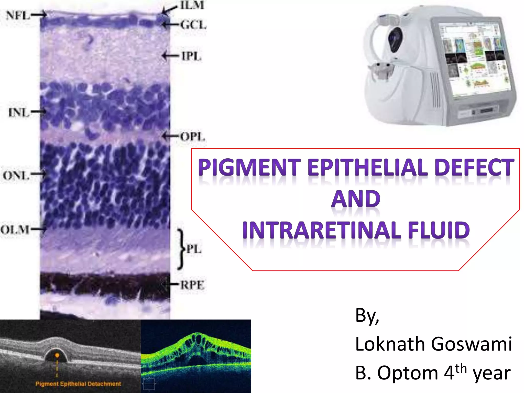 Pigment epithelial defect and intraretinal fluid | PPT