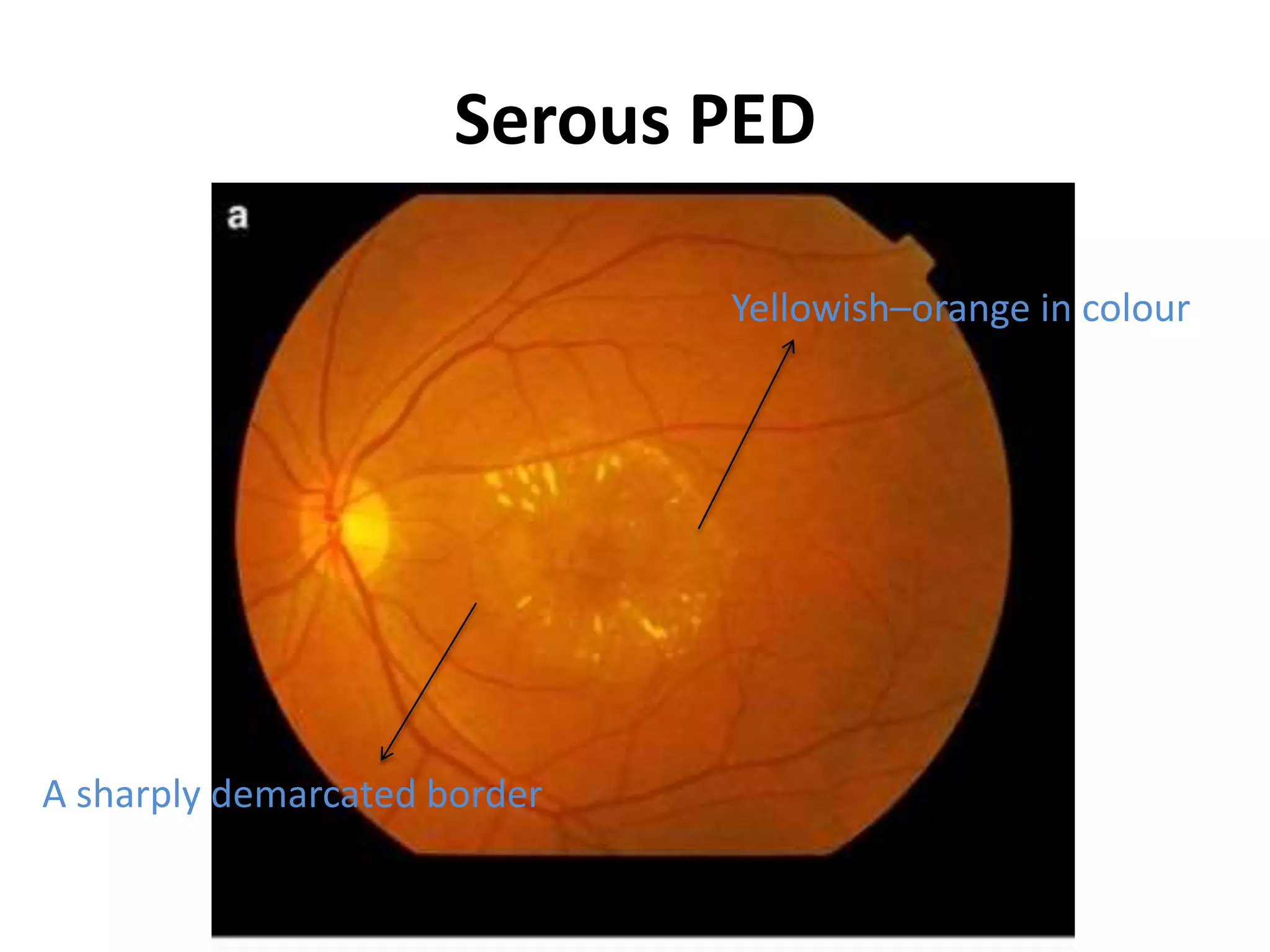 Pigment epithelial defect and intraretinal fluid | PPT
