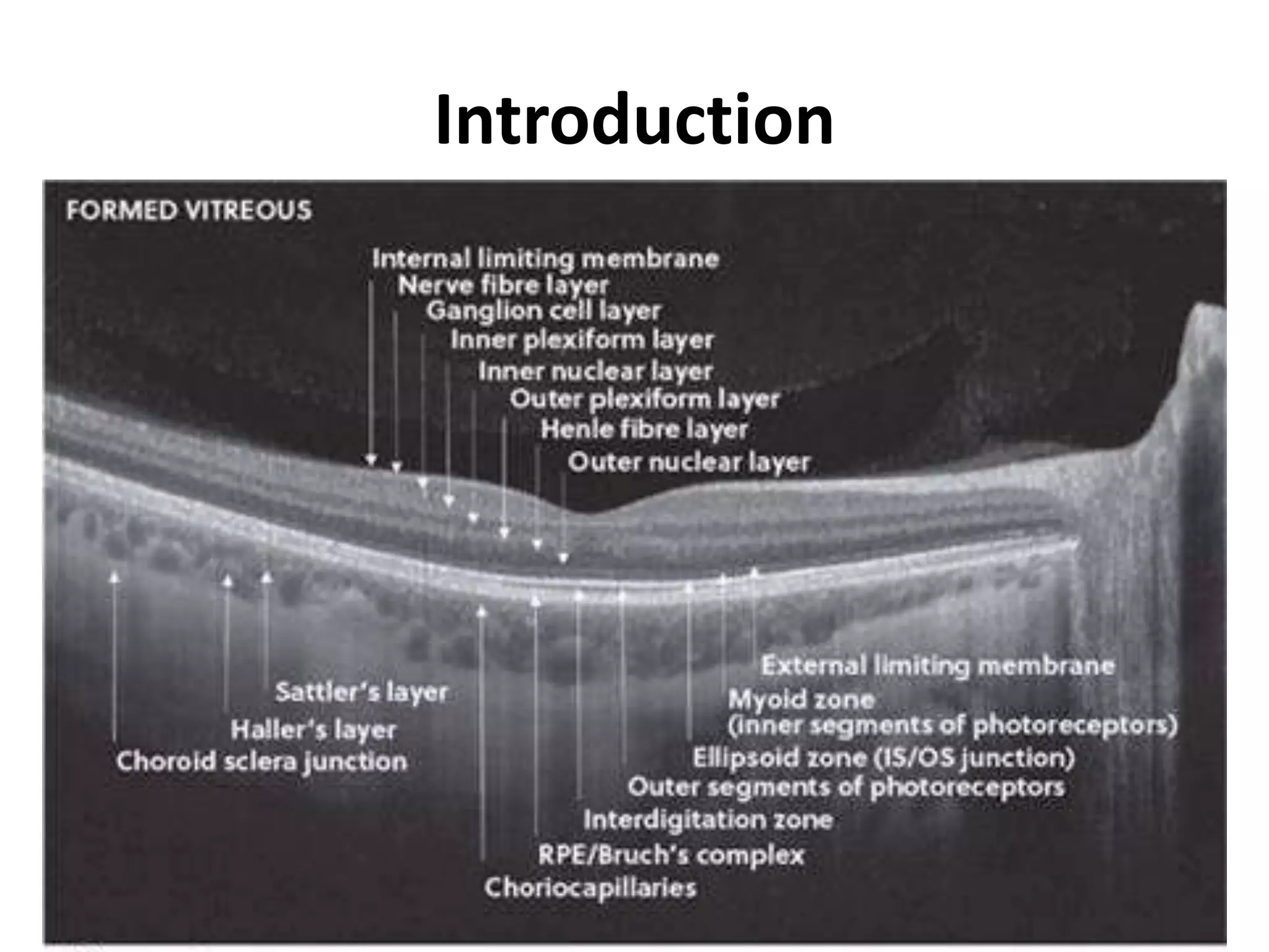 Pigment epithelial defect and intraretinal fluid | PPT