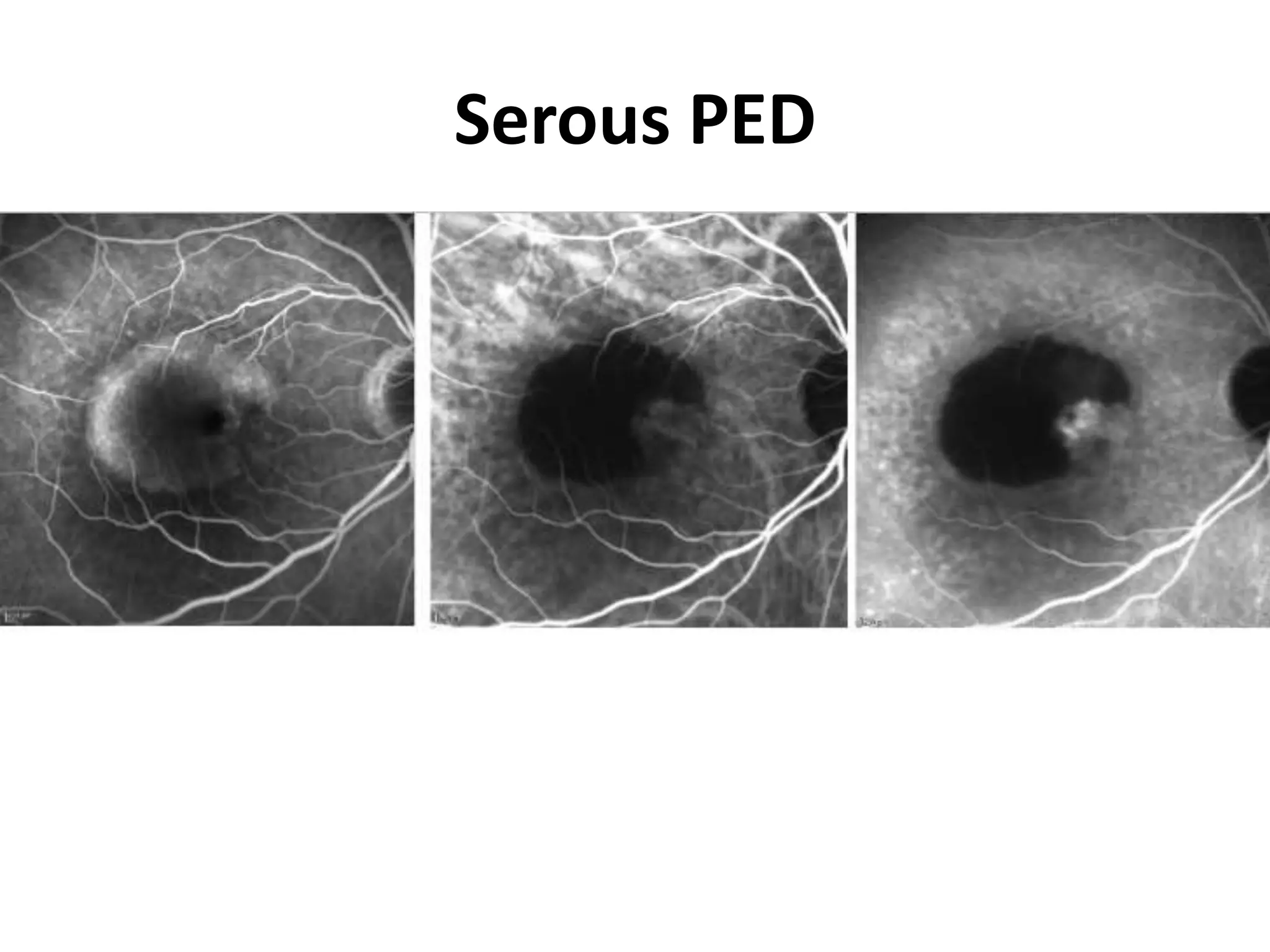 Pigment epithelial defect and intraretinal fluid | PPTX