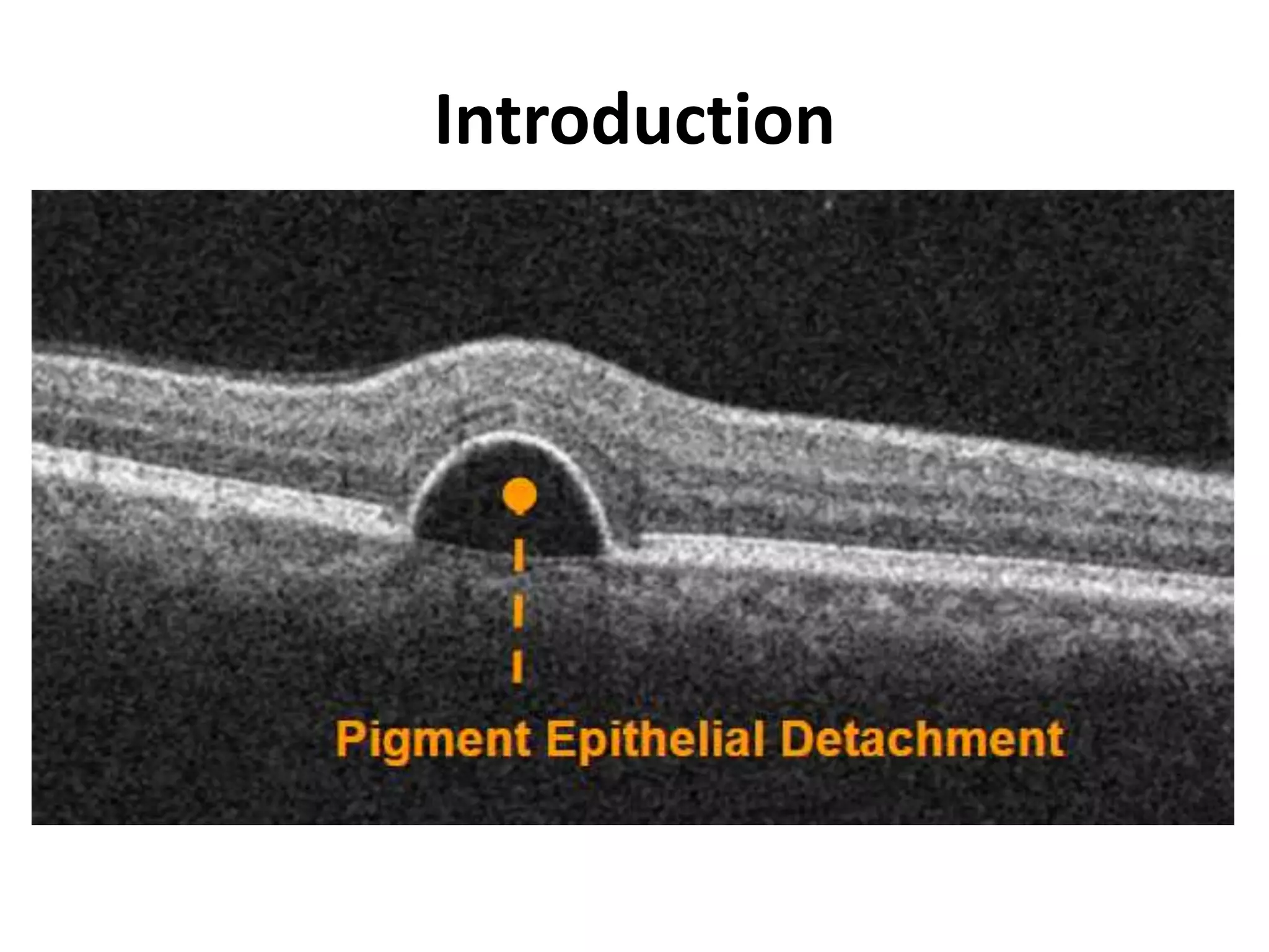 Pigment epithelial defect and intraretinal fluid | PPT