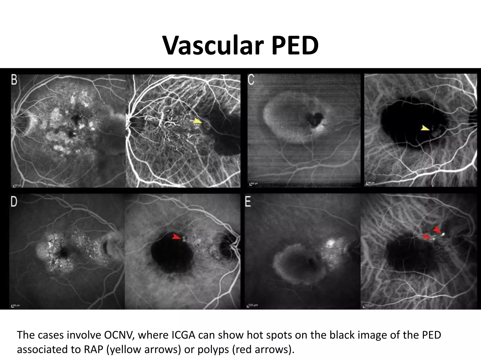 Pigment epithelial defect and intraretinal fluid | PPT