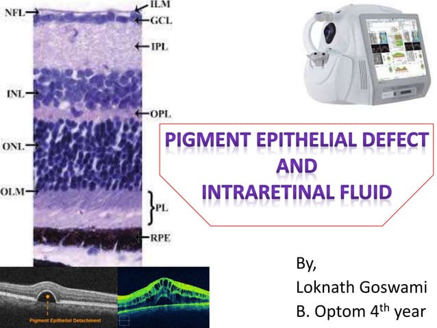 Pigment epithelial defect and intraretinal fluid | PPT