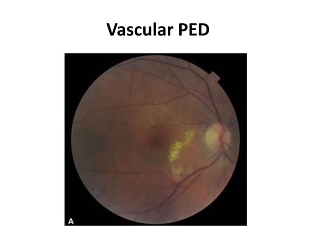 Pigment epithelial defect and intraretinal fluid | PPT
