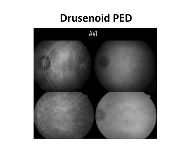 Pigment epithelial defect and intraretinal fluid | PPT
