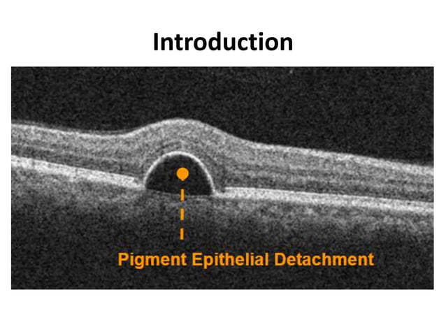 Pigment epithelial defect and intraretinal fluid | PPT