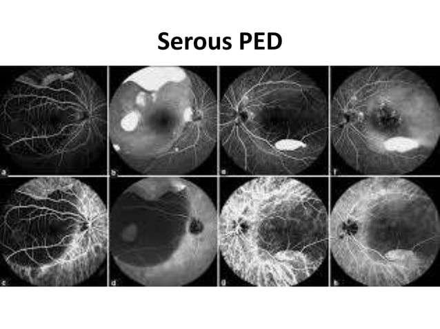 Pigment epithelial defect and intraretinal fluid | PPT