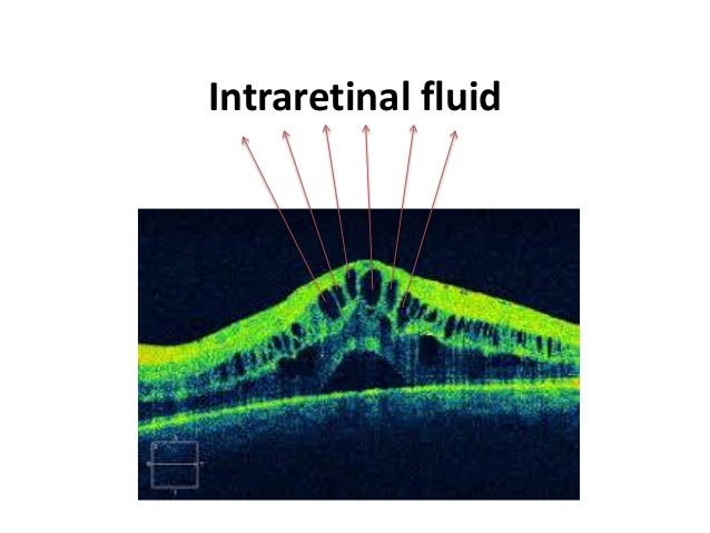 Pigment epithelial defect and intraretinal fluid