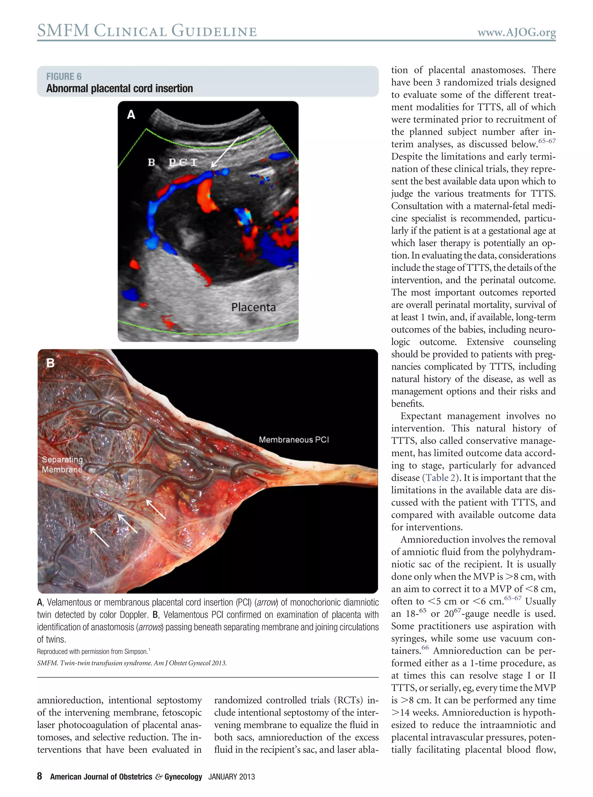 Twin-twin transfusion syndrome | PDF