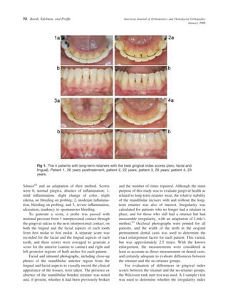20 Year follow up of lingually bonded retainers | PDF