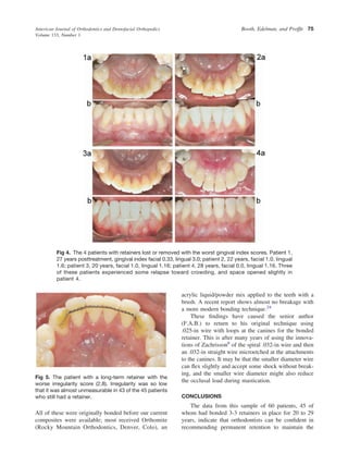 20 Year follow up of lingually bonded retainers | PDF