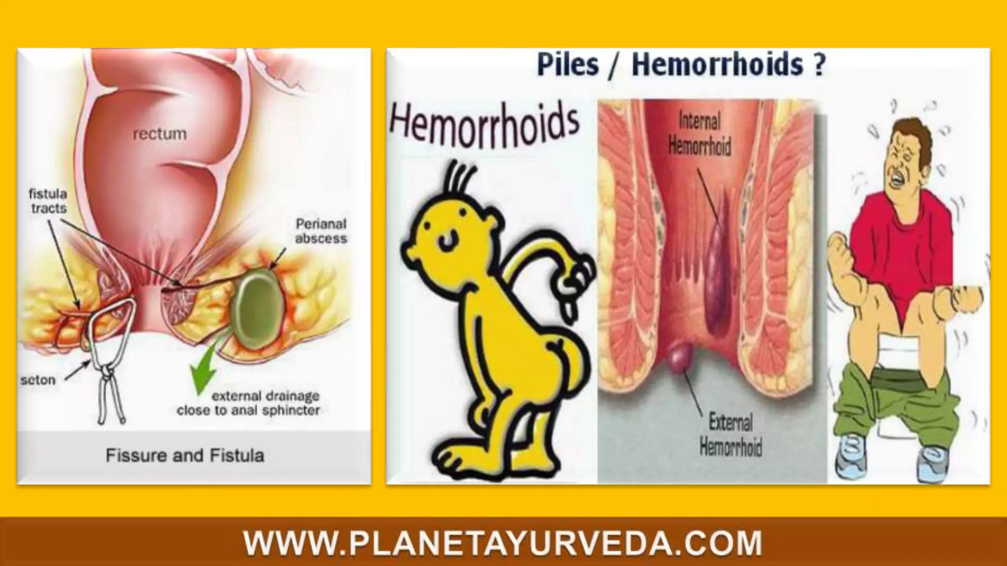 Piles Fissure-Fistula - Diet And Natural Treatment | PPT