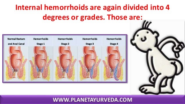 Natural Treatment For Piles ( Hemorrhoids )- Causes, Symptoms, Types