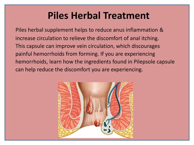 Piles13 | PPTX | Herbs and Supplements | Alternative Medicine